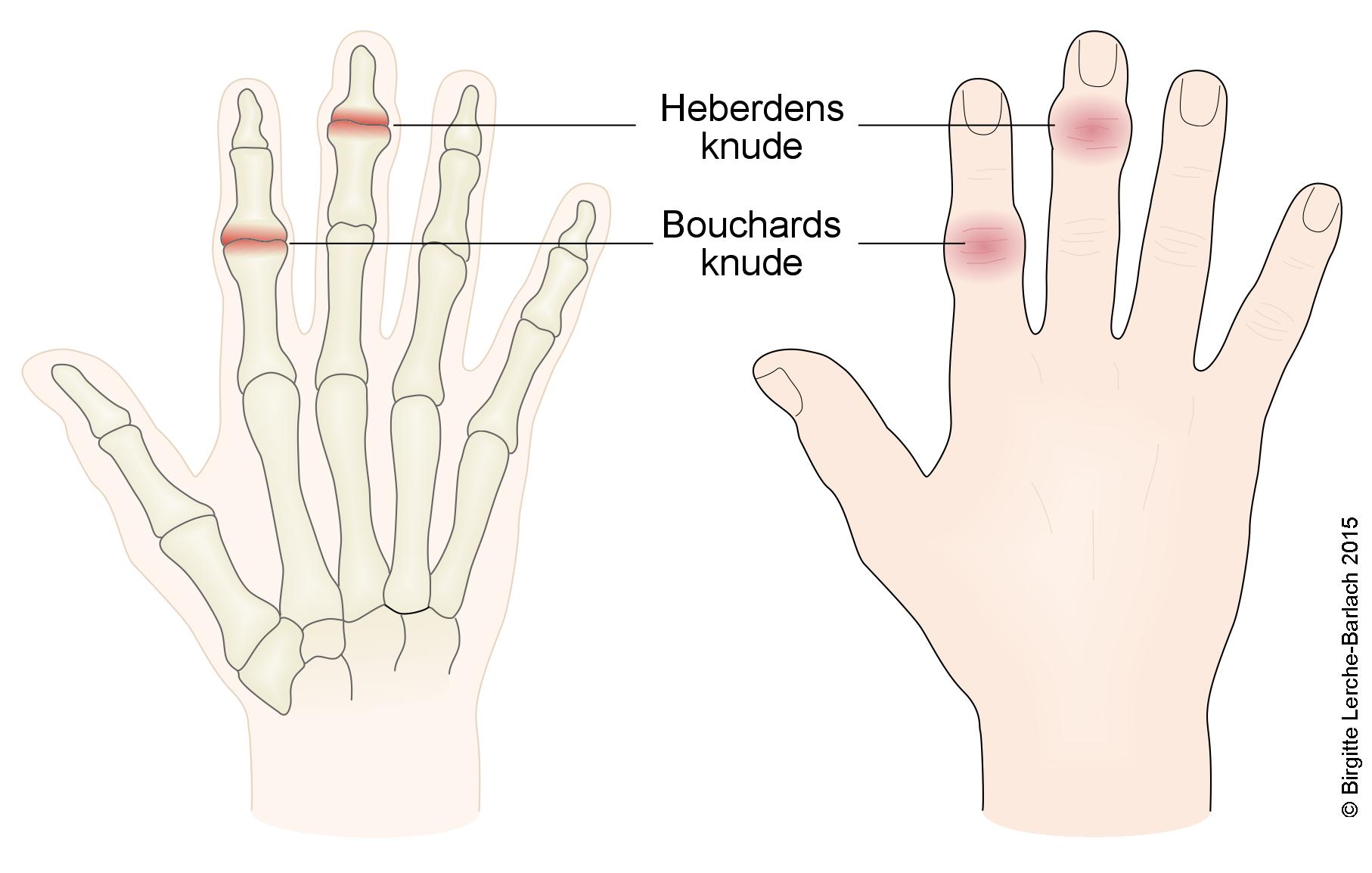 Heberdens knuder - Patienthåndbogen på sundhed.dk