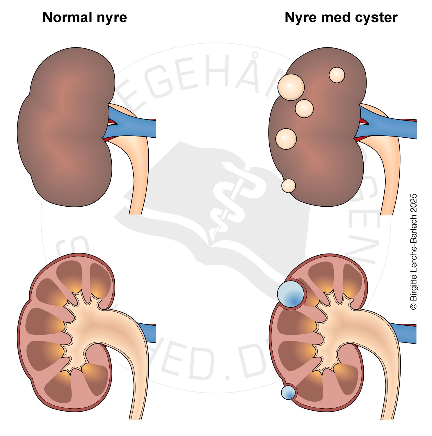 Nyrecyste (CT-scanning) - Lægehåndbogen på sundhed.dk