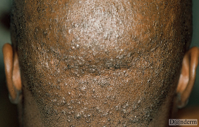 Akne - Lægehåndbogen på sundhed.dk