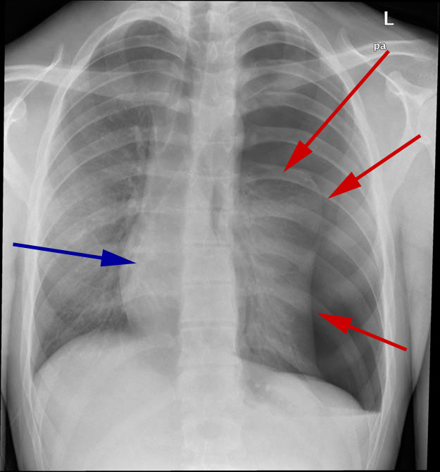 Lunger, Pneumothorax, Røntgen - Lægehåndbogen på sundhed.dk