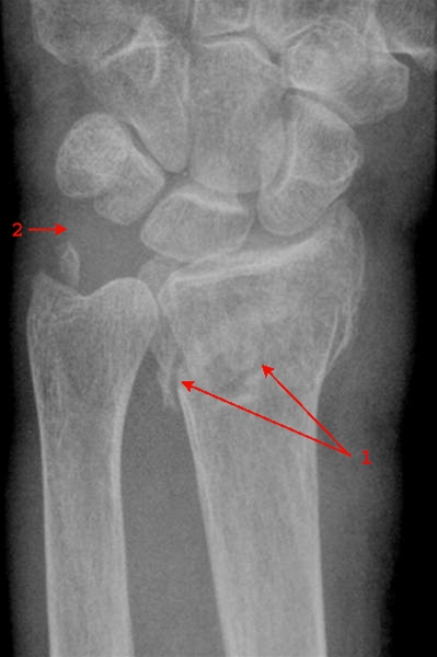 Radiusfraktur, front - Lægehåndbogen på sundhed.dk