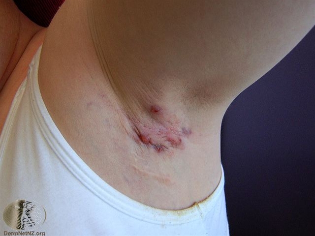 Hidrosadenitis - Patienthåndbogen på sundhed.dk