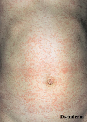 Udslæt med feber - Patienthåndbogen på sundhed.dk