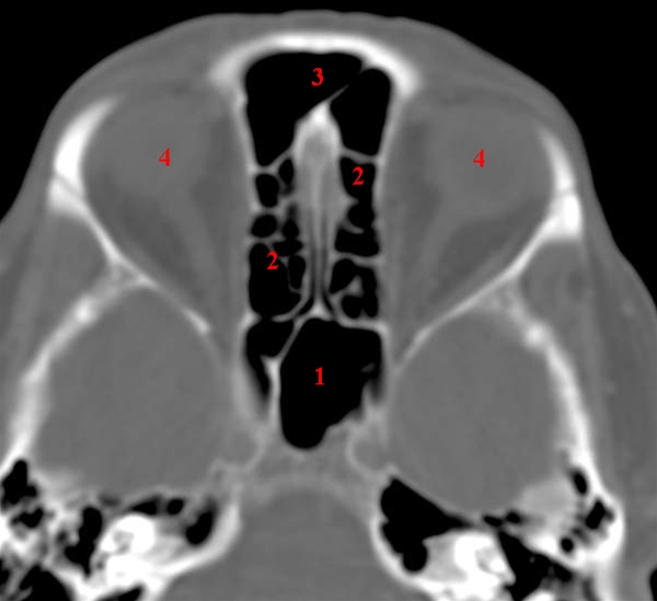 Sinus ethmoidales og sphenoidalis, axial, CT - Lægehåndbogen på sundhed.dk