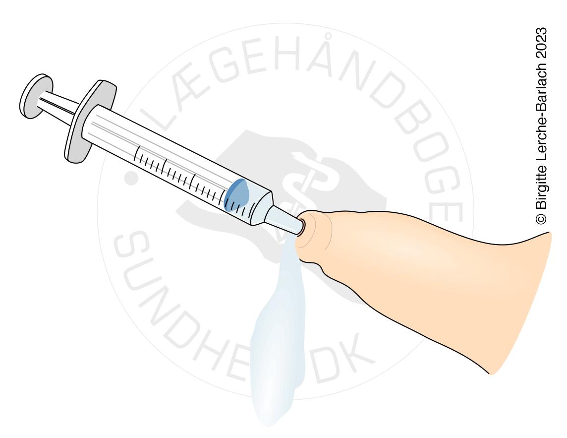 Balanitis - Skyllebehandling - Patienthåndbogen på sundhed.dk