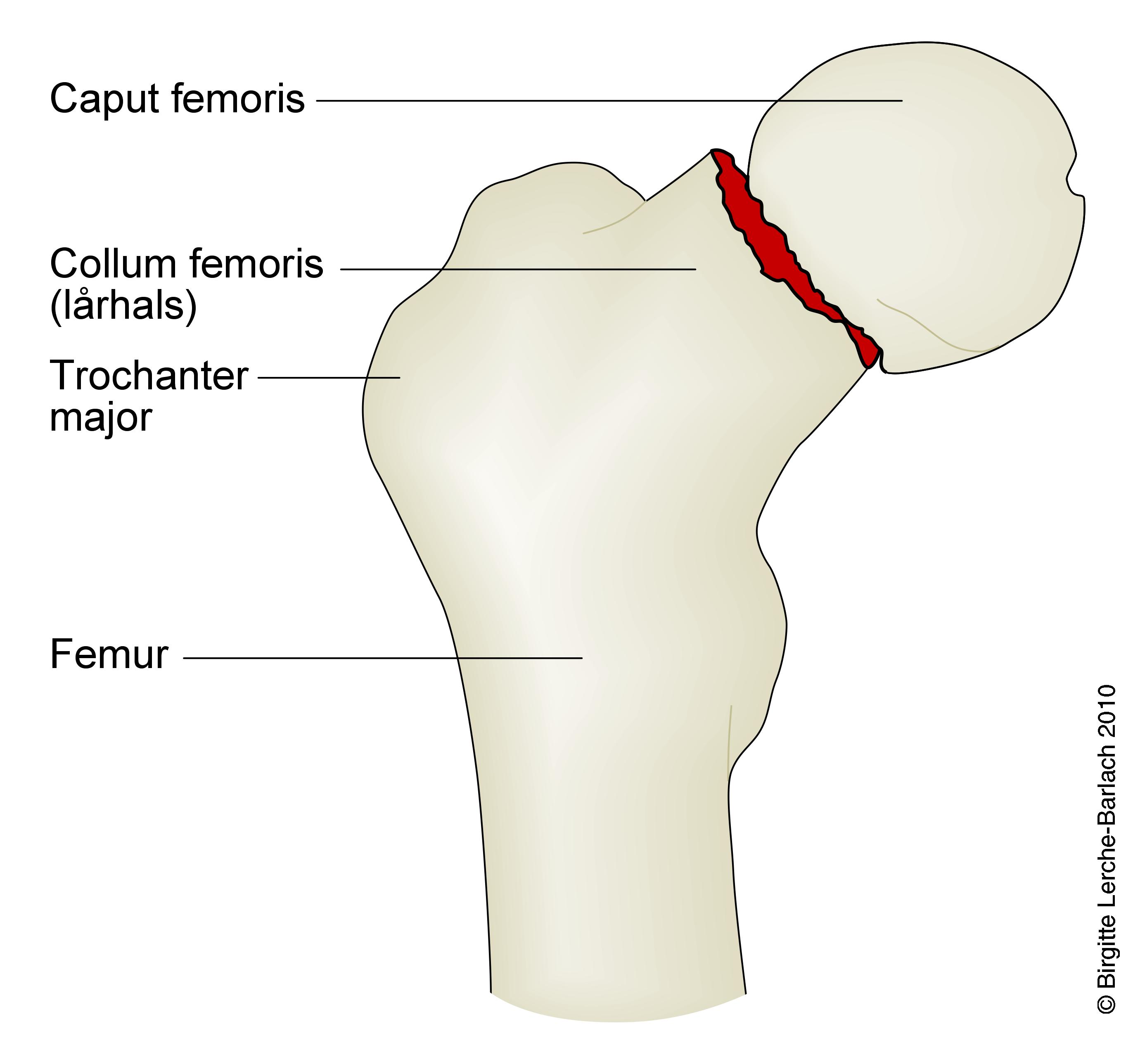 Collum femoris fraktur, mindre dislokation - Patienthåndbogen på sundhed.dk