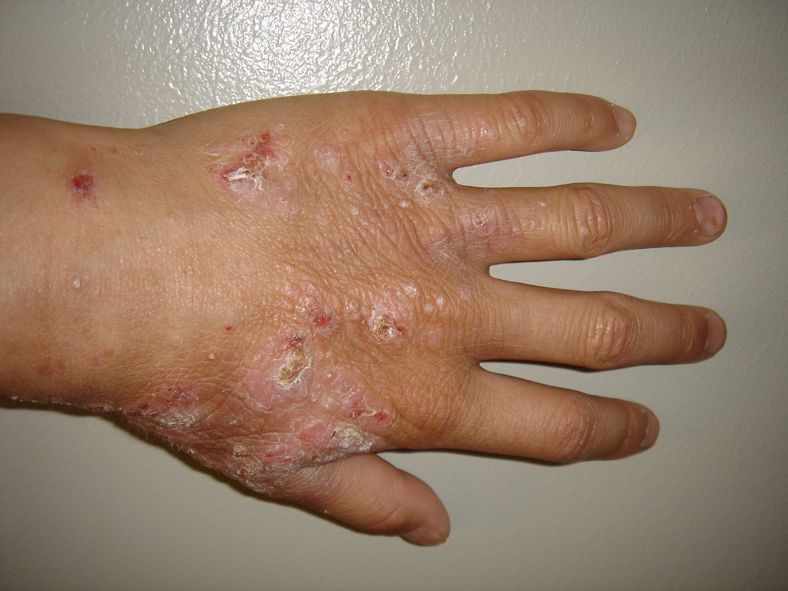 Atopisk eksem - Lægehåndbogen på sundhed.dk