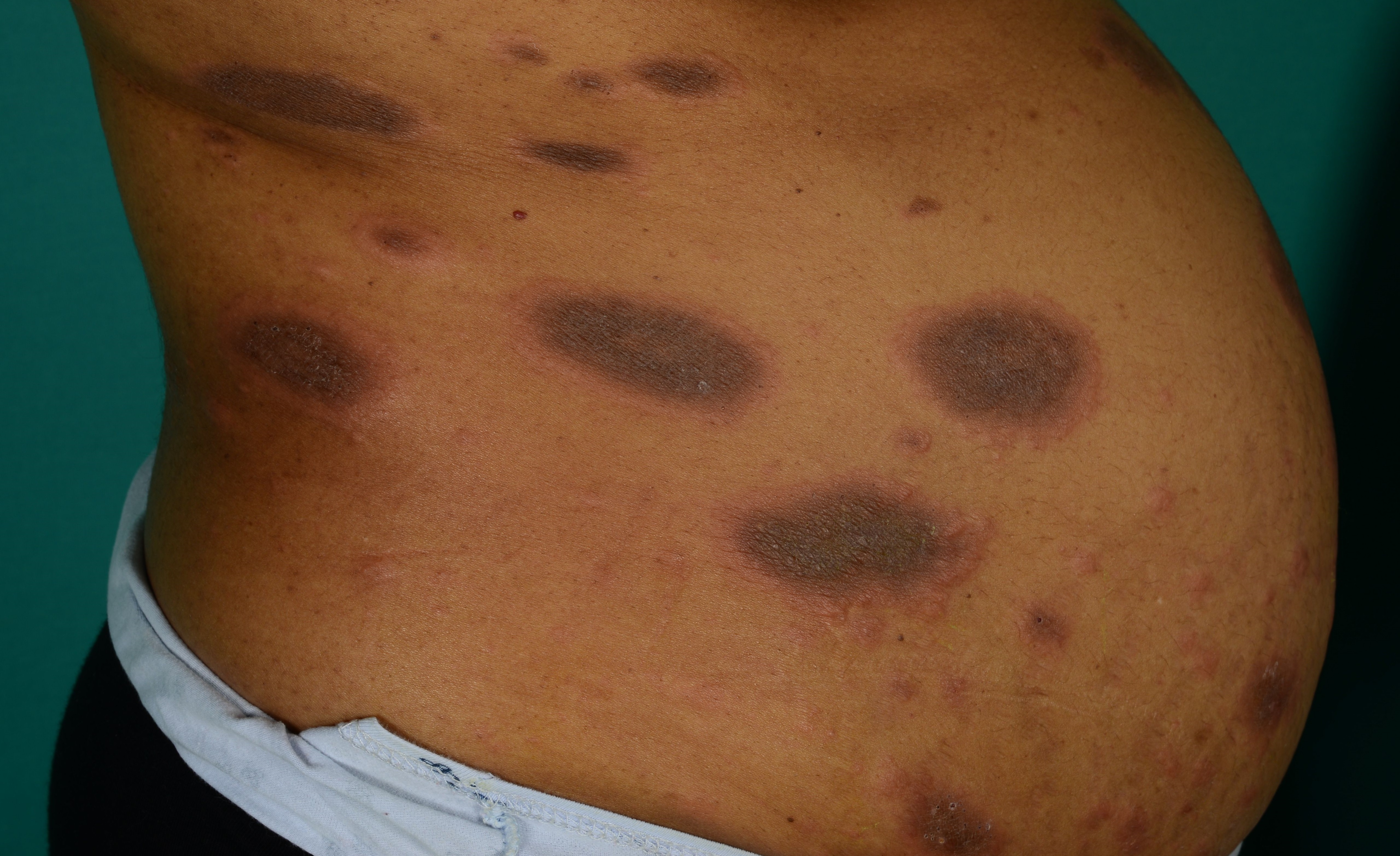 Graviditets pemfigoid - Patienthåndbogen på sundhed.dk