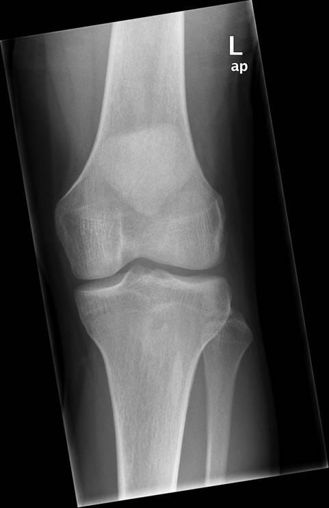 Knæ, Normal, Røntgen - Lægehåndbogen på sundhed.dk