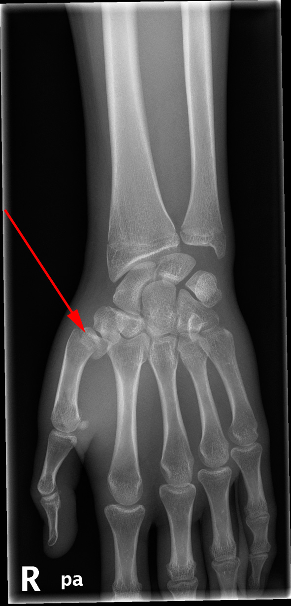 Hånd, Fraktur, Røntgen - Lægehåndbogen på sundhed.dk