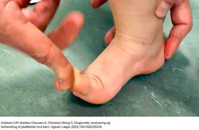 Platfod - Lægehåndbogen på sundhed.dk