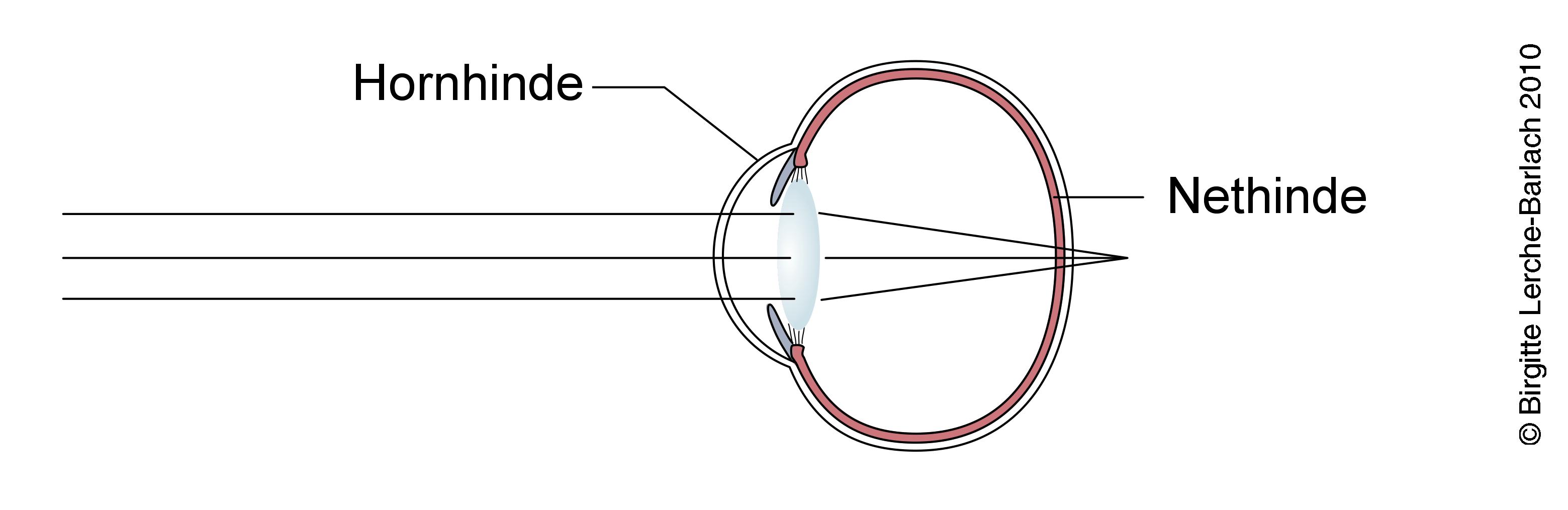 Langsynethed (hypermetropi) - Patienthåndbogen på sundhed.dk