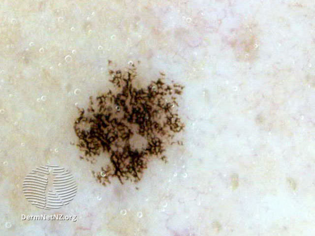 Ink spot lentigo - Lægehåndbogen på sundhed.dk