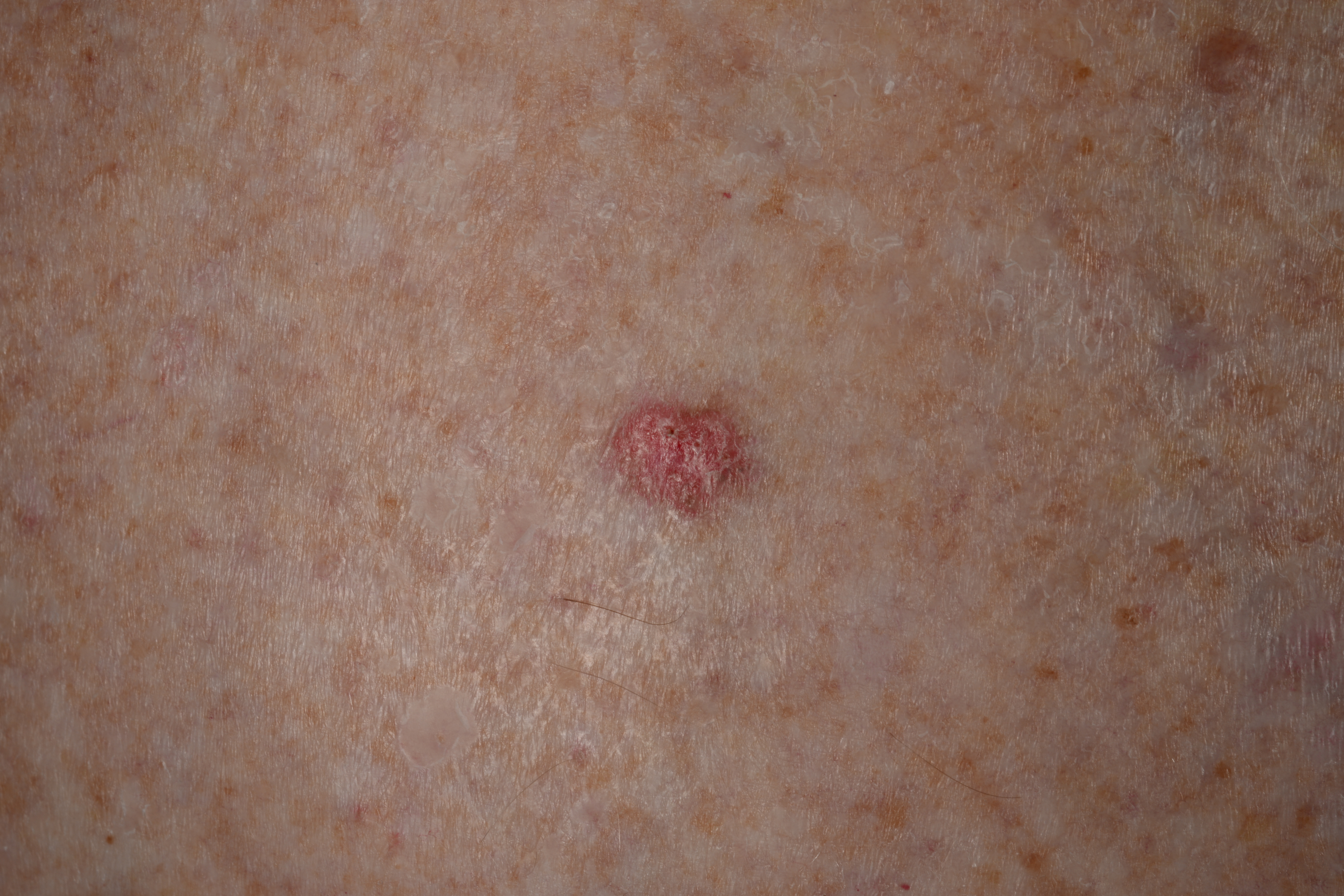 Dermatoskopi - Lægehåndbogen på sundhed.dk