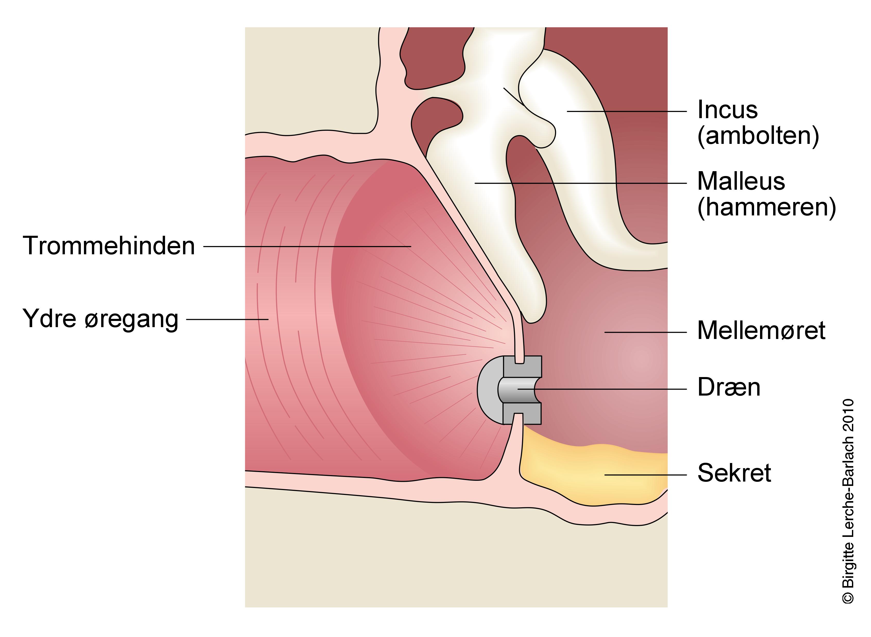 Trommehinde med dræn, tværsnit - Patienthåndbogen på sundhed.dk