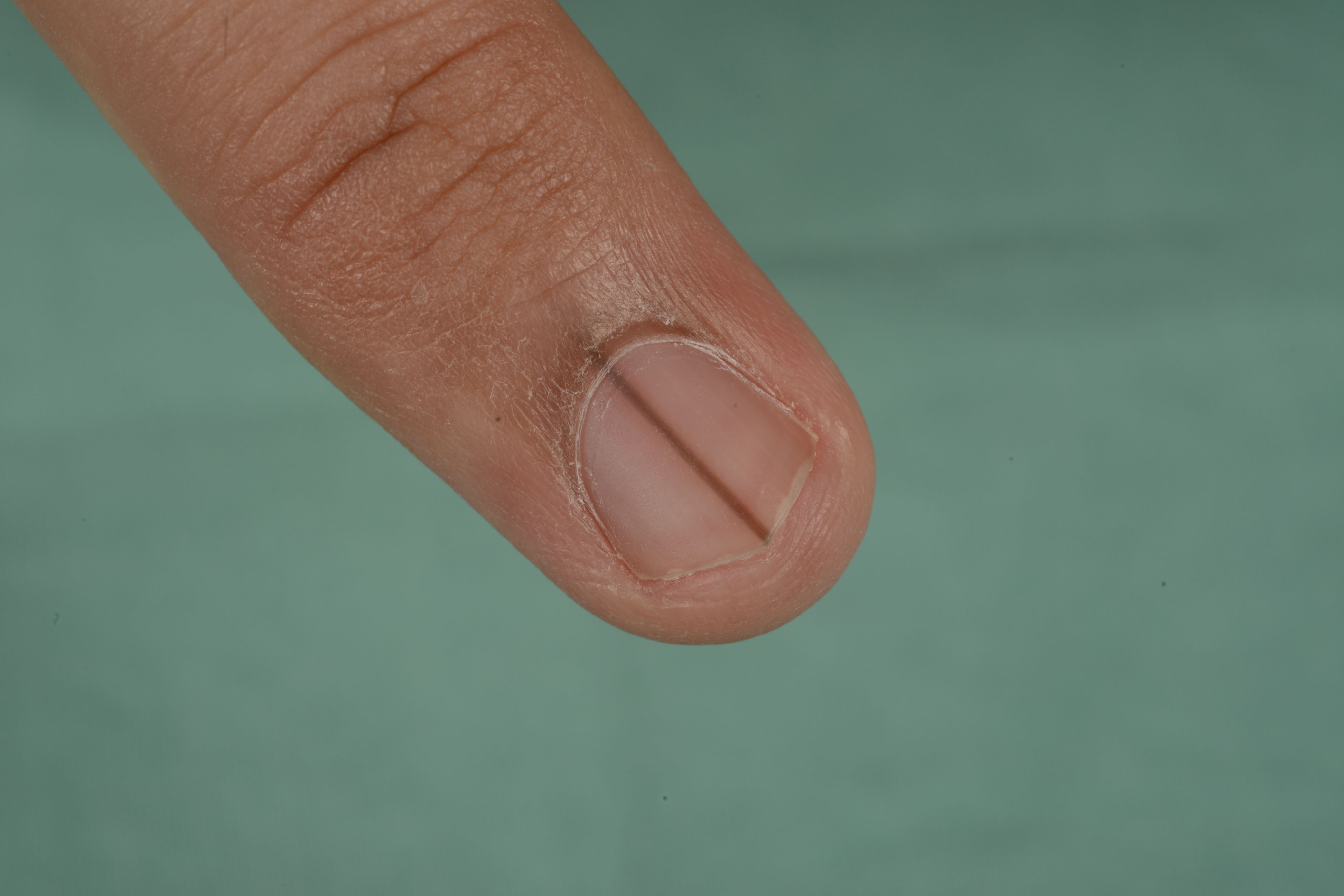 Melanonychia - Lægehåndbogen på sundhed.dk