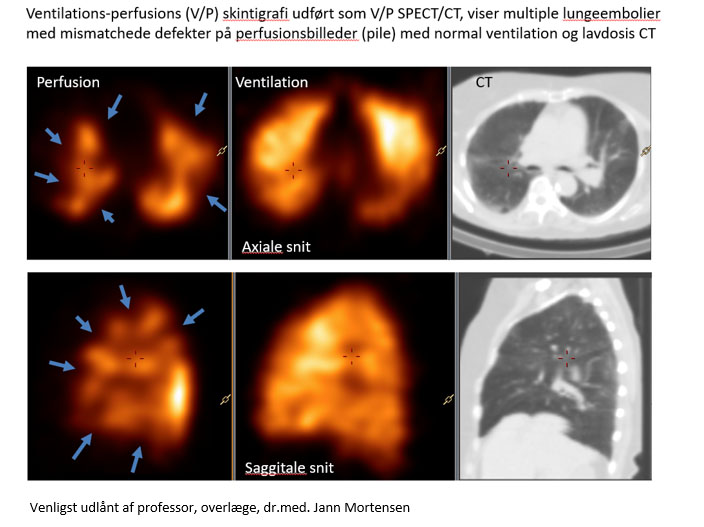 Lungeemboli, skintigrafi - Patienthåndbogen på sundhed.dk