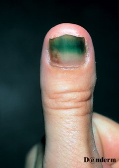 Sårinfektioner - Lægehåndbogen på sundhed.dk