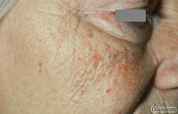 Solskoldning, solforbrænding, solskader - Patienthåndbogen på sundhed.dk