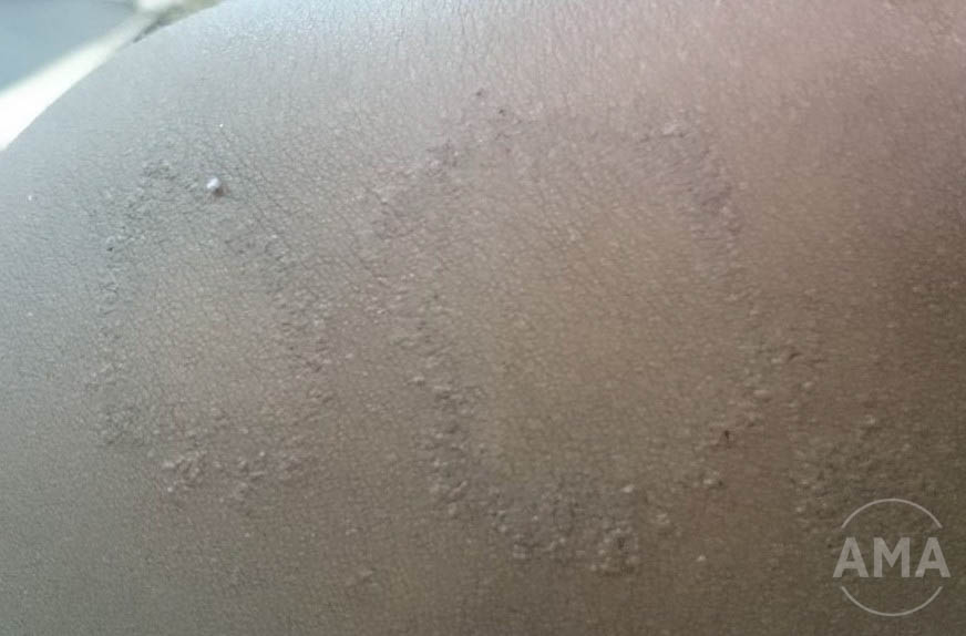 Ringorm - Patienthåndbogen på sundhed.dk