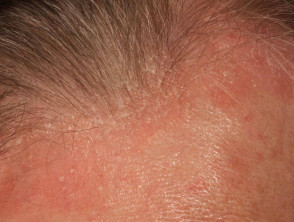 Hårbundsforandringer - Lægehåndbogen på sundhed.dk