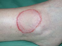 Tinea corporis (ringorm) - Lægehåndbogen på sundhed.dk