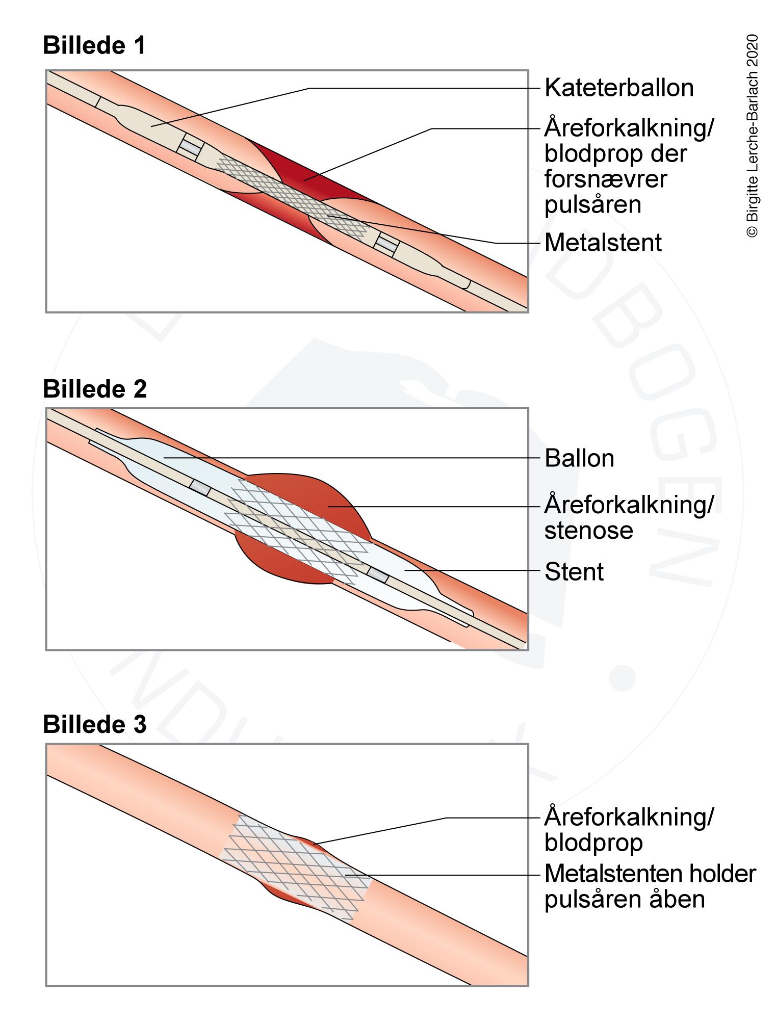 Perkutan koronar intervention - Patienthåndbogen på sundhed.dk
