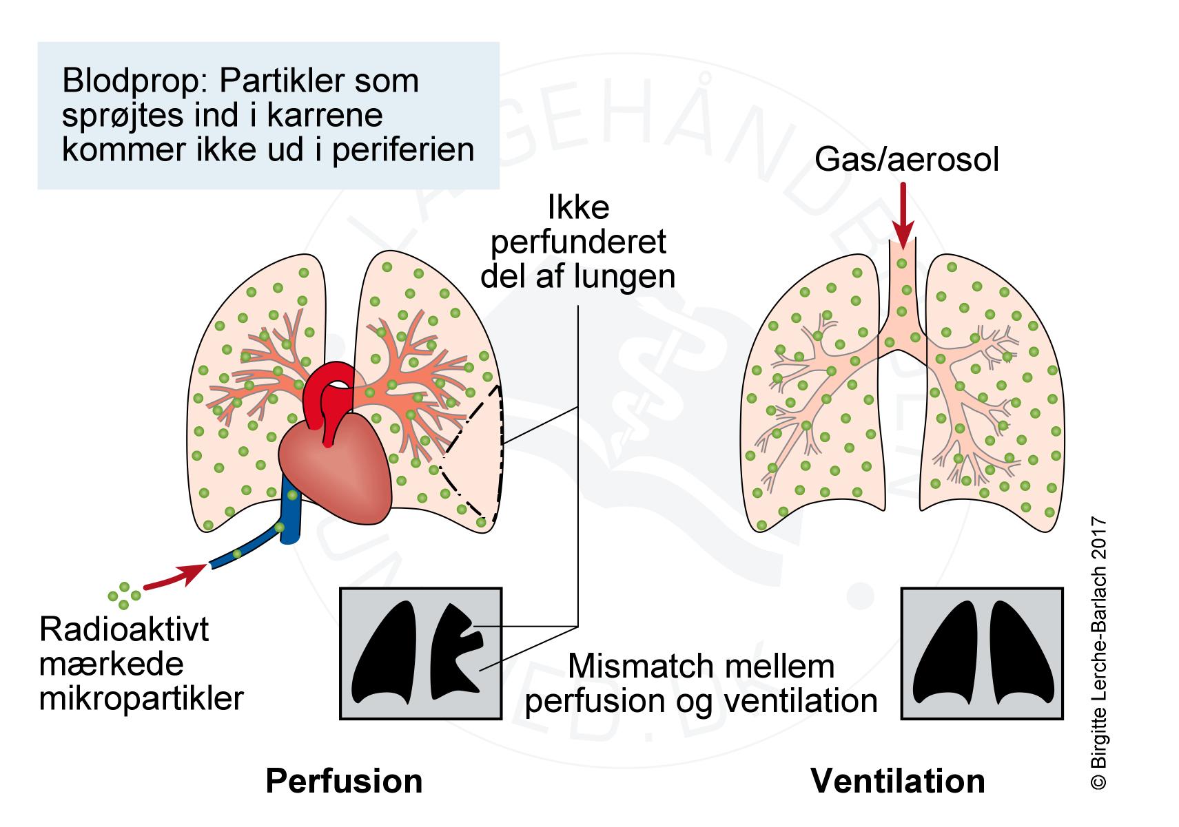 Perfusionsscintigrafi ved lungeemboli - Lægehåndbogen på sundhed.dk