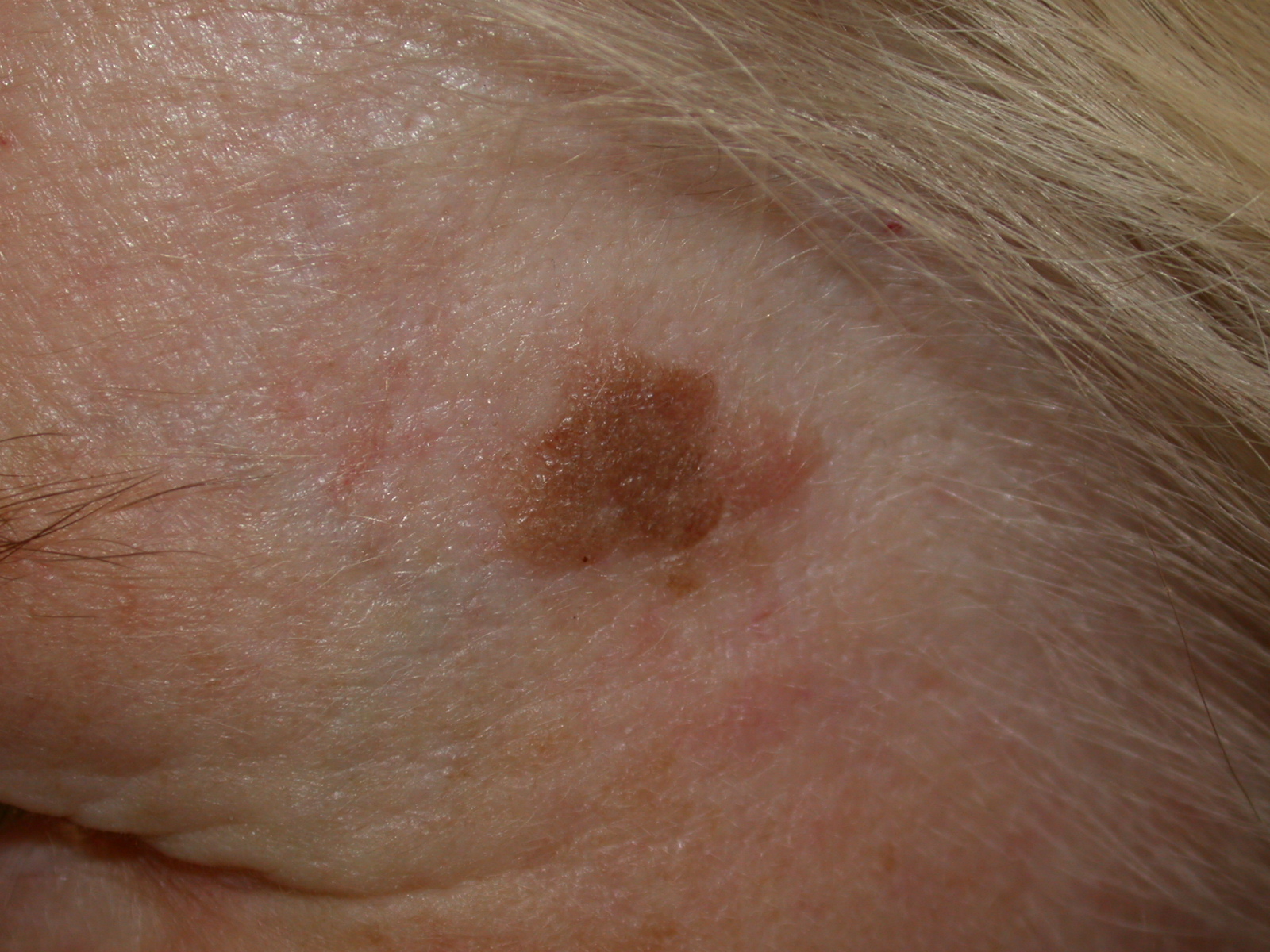 Seboroiske vorter - Lægehåndbogen på sundhed.dk