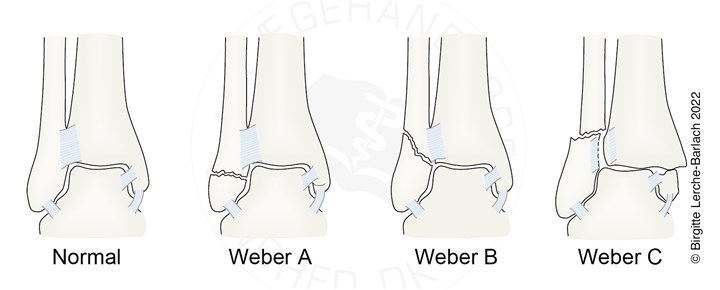 Ankel, frakturer - Lægehåndbogen på sundhed.dk